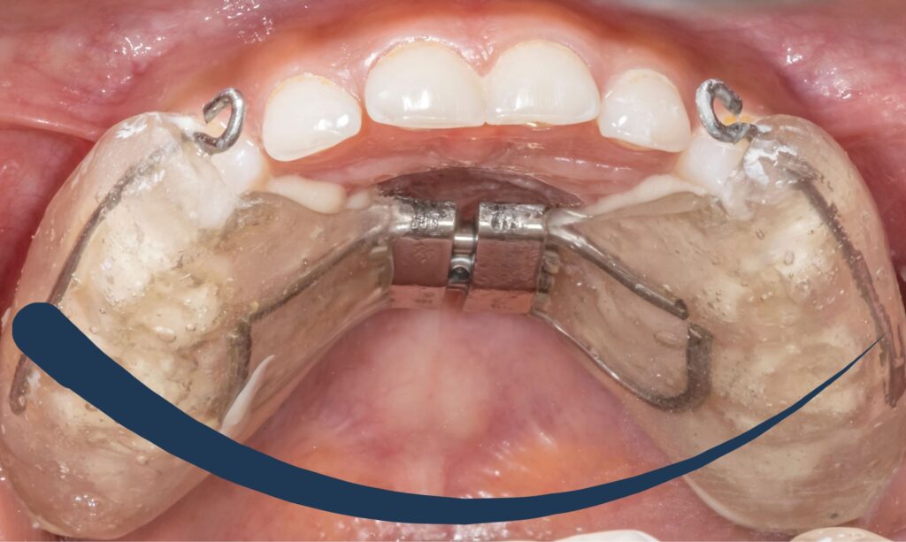 5 Reasons Your Child Needs a Palatal Expander
